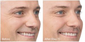 Botox Miami & Miami Beach