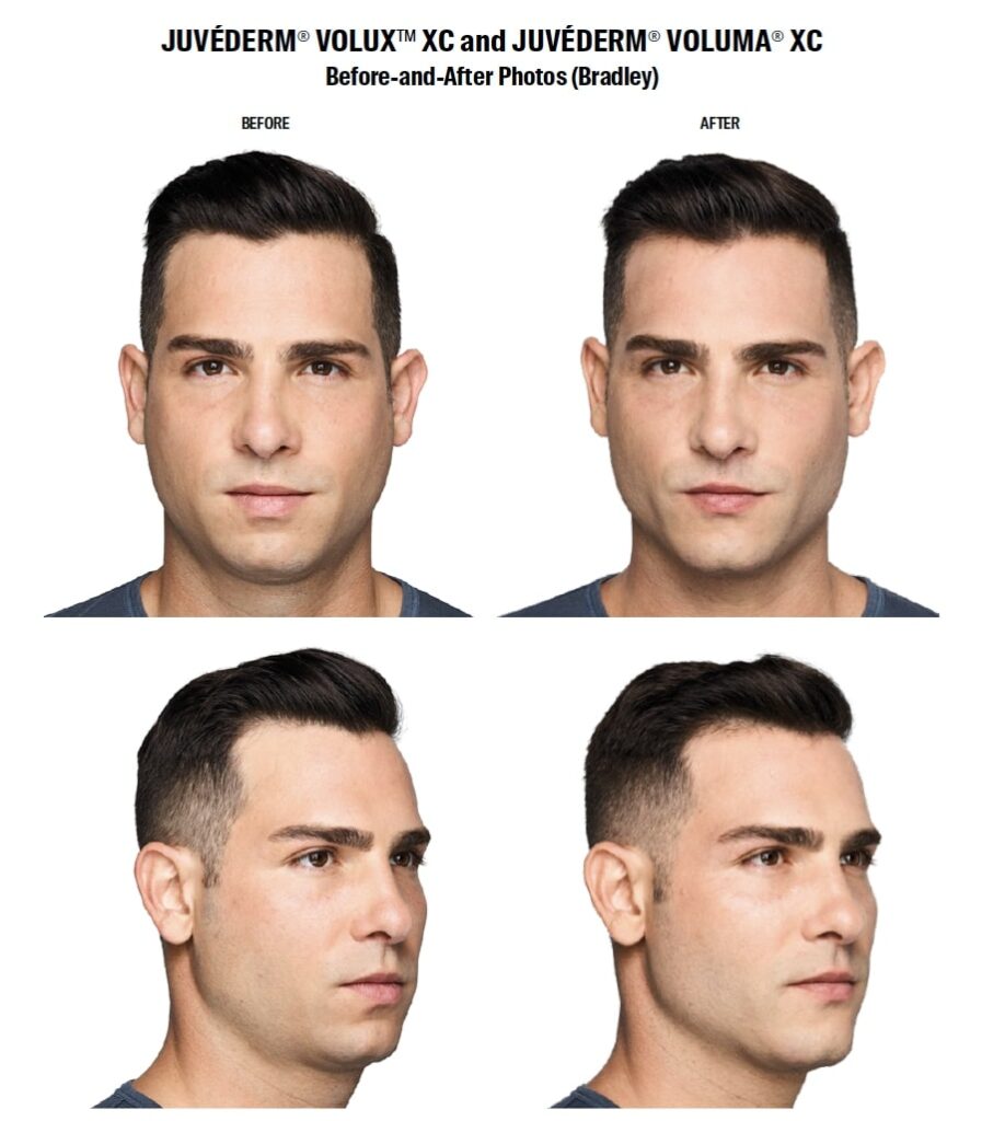 Juvéderm® Volux® XC - Miami Beach Laser & Aesthetics